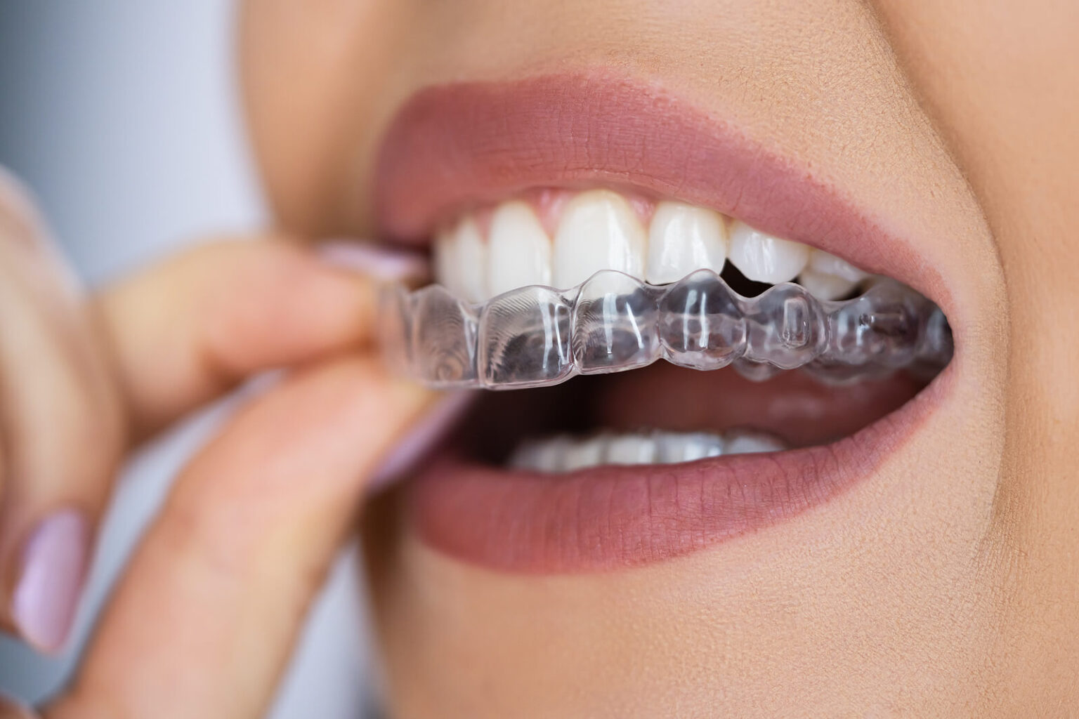 Top Benefits of Affordable Orthodontic Braces - All About Orthodontics